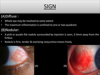 Diffuse Episcleritis