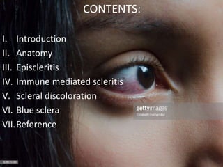 Episcleritis Vs Scleritis