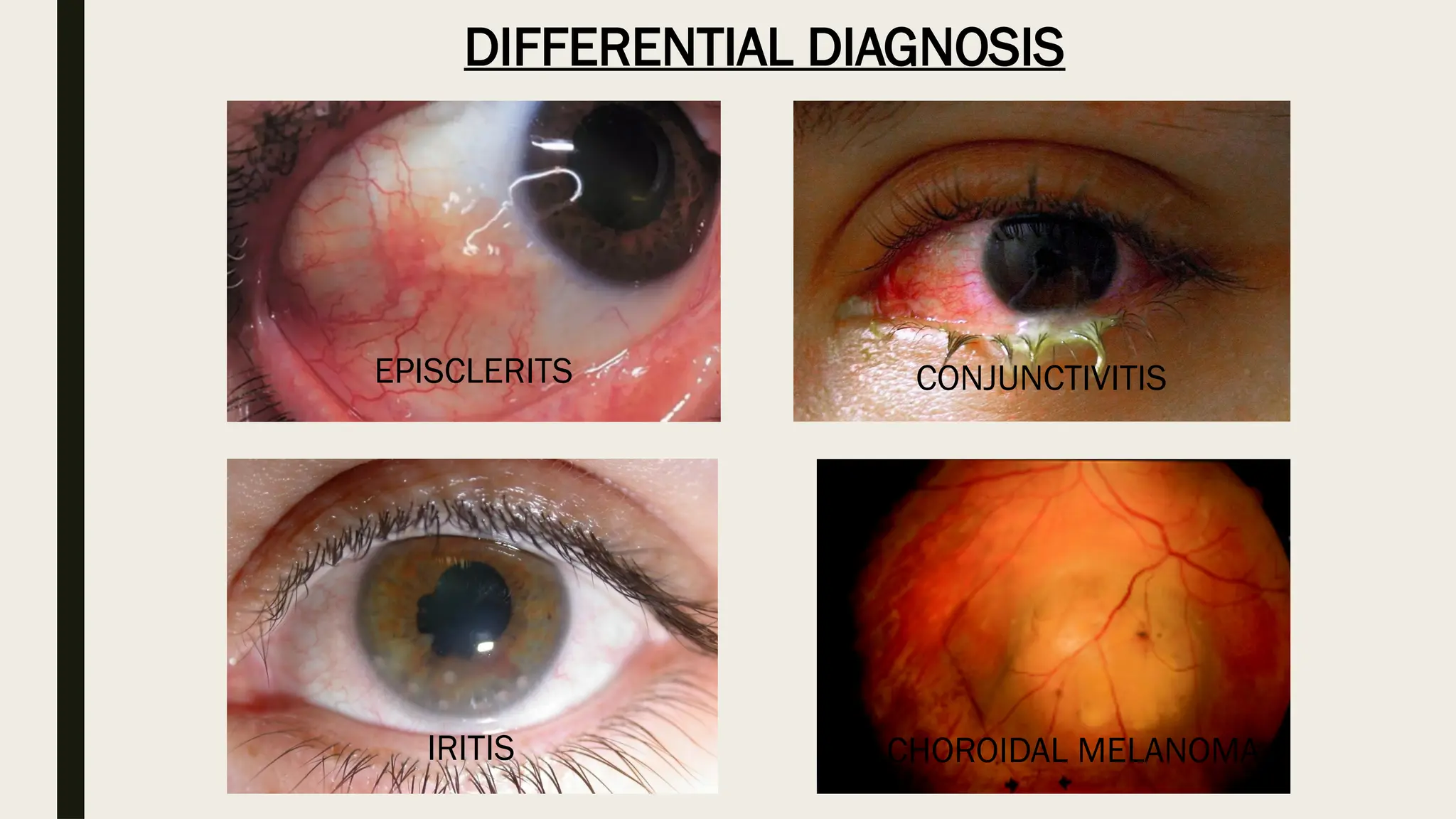 Episcleritis & Scleritis (causes, clinical features, treatment).pptx