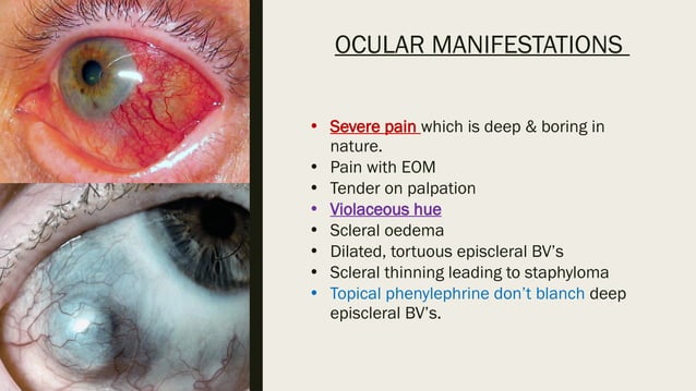 Episcleritis & Scleritis (causes, clinical features, treatment).pptx