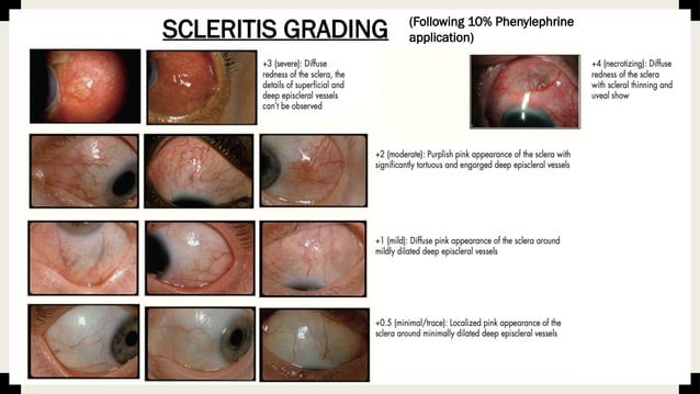 Episcleritis & Scleritis (causes, clinical features, treatment).pptx