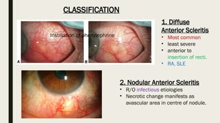 Episcleritis & Scleritis (causes, clinical features, treatment).pptx