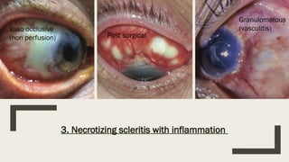 Episcleritis & Scleritis (causes, clinical features, treatment).pptx
