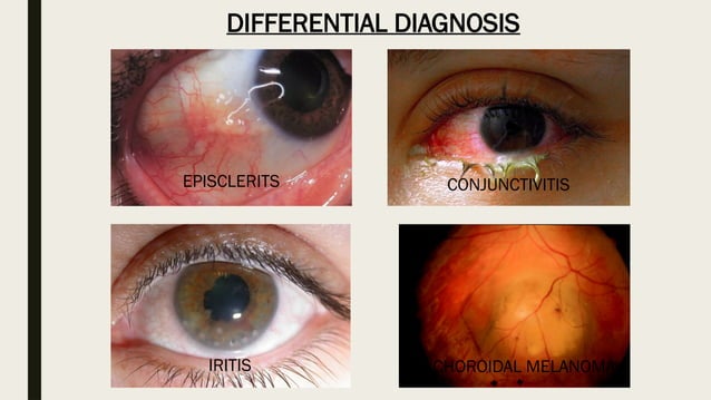 Episcleritis & Scleritis (causes, clinical features, treatment).pptx