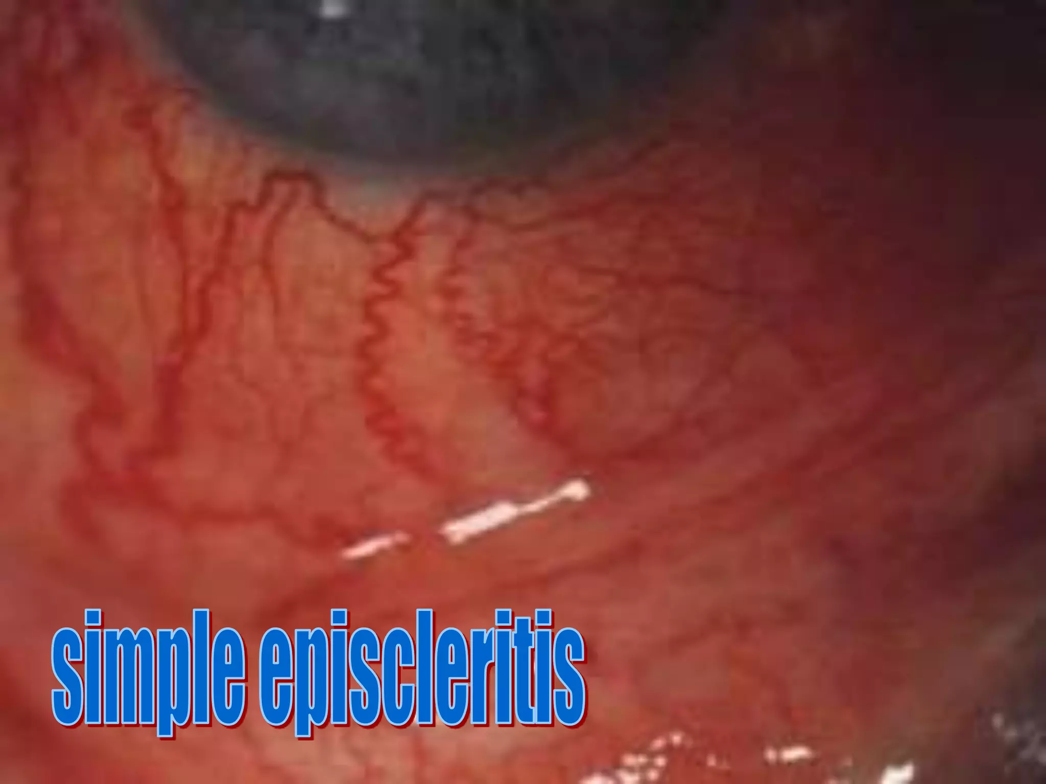 Episcleritis & scleritis | PPT