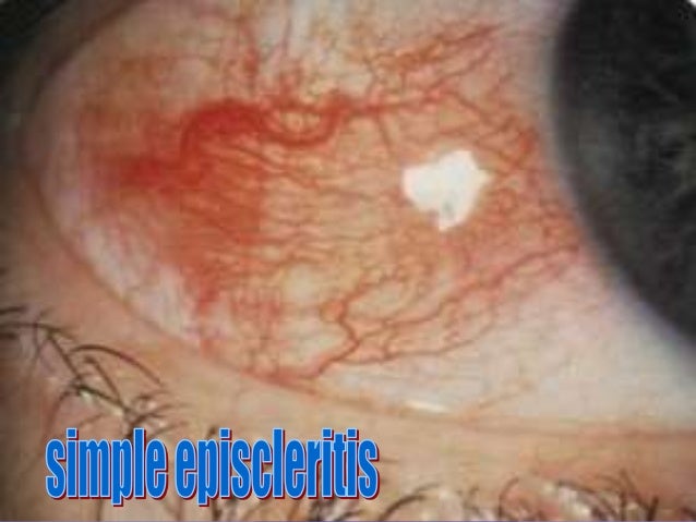 Episcleritis & scleritis