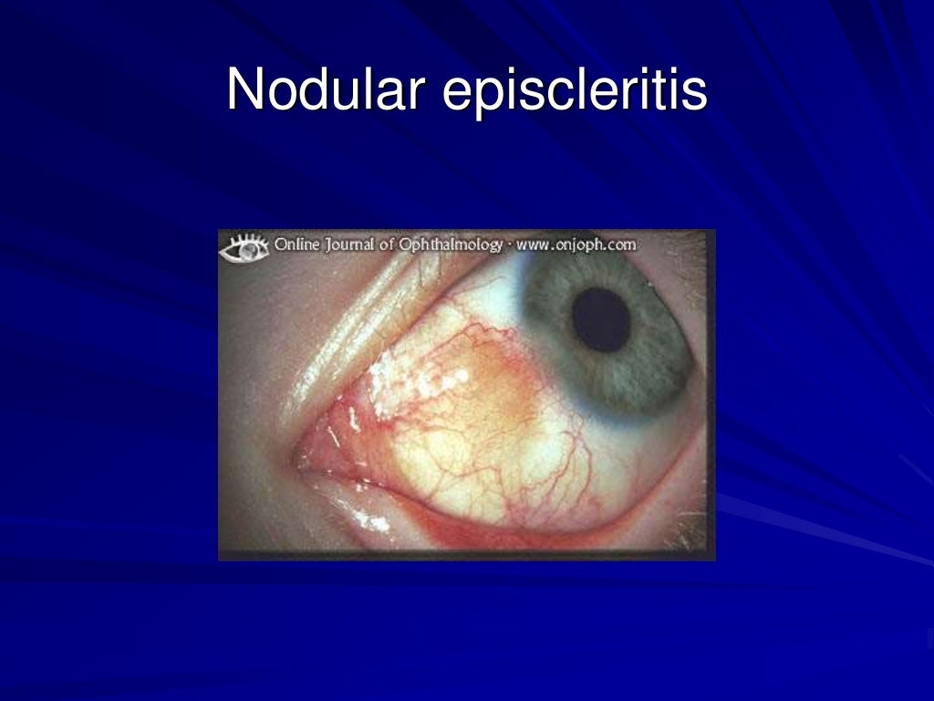 Episcleritis & scleritis