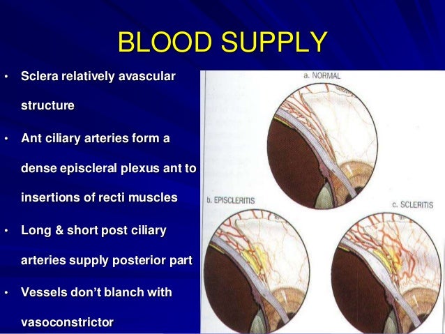 Episcleritis & scleritis