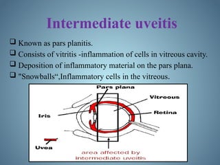 EPISCLERITIS & UVEITIS.ppt eye disorders | PPT