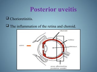 EPISCLERITIS & UVEITIS.ppt eye disorders | PPT