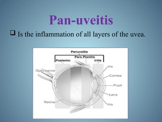 EPISCLERITIS & UVEITIS.ppt eye disorders | PPT