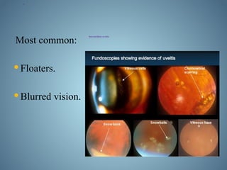 EPISCLERITIS & UVEITIS.ppt eye disorders | PPT