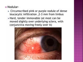 EPISCLERITIS & UVEITIS.ppt eye disorders | PPT