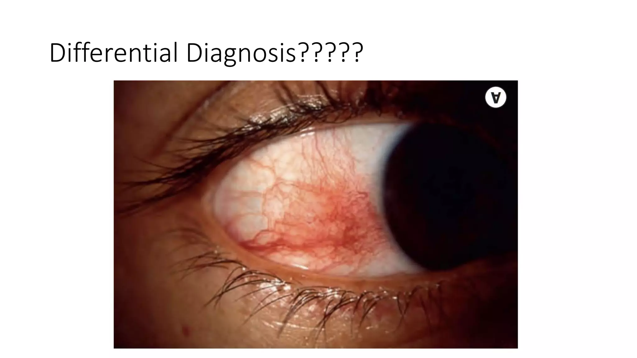Episcleritis | PPTX