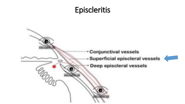 Episcleritis | PPTX | Eye and Vision Conditions | Diseases and Conditions