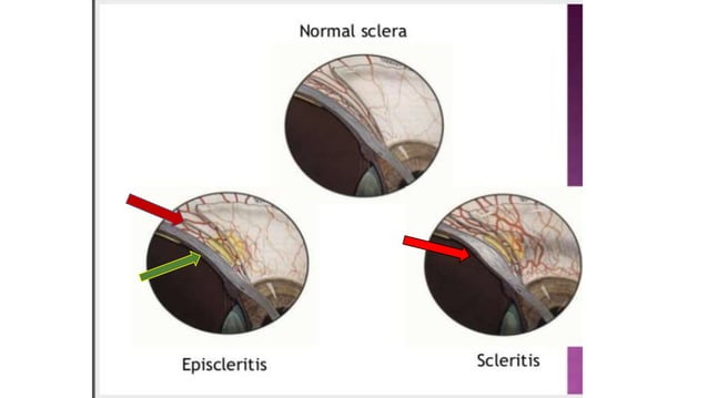 Episcleritis | PPTX | Eye and Vision Conditions | Diseases and Conditions