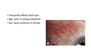 Episcleritis | PPTX