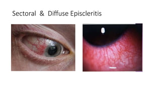 Episcleritis | PPTX