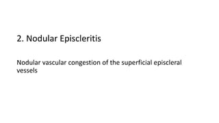 Episcleritis | PPTX