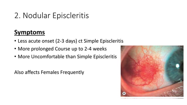 Episcleritis | PPTX | Eye and Vision Conditions | Diseases and Conditions