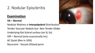 Episcleritis | PPTX