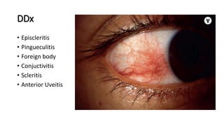 Episcleritis | PPTX