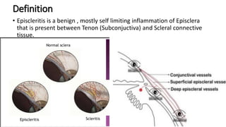 Episcleritis | PPTX