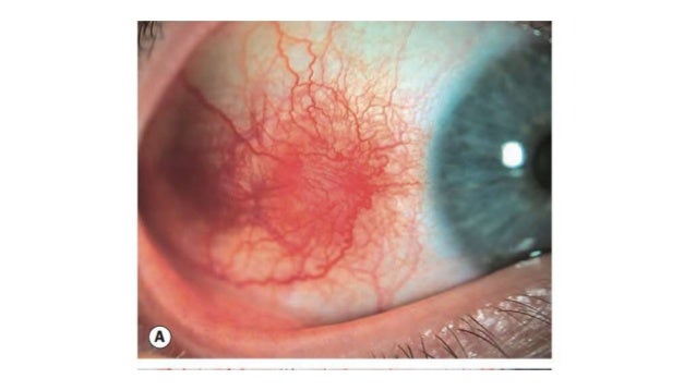 Episcleritis