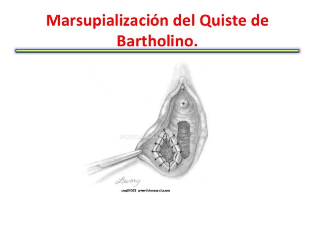 Episiotomía