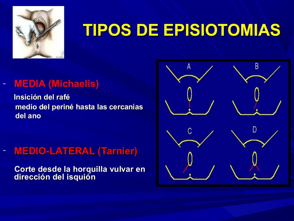 Episiotoma y episiorrafia