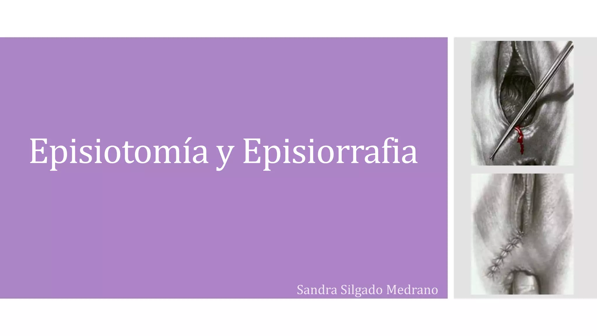 Episiotomia y-episiorrafia | PPTX