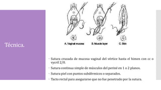 Episiotomia Y Episiorrafia Pptx