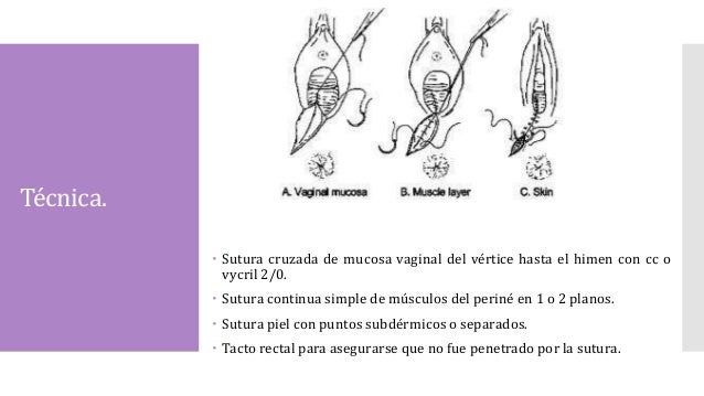 Episiotomia y-episiorrafia