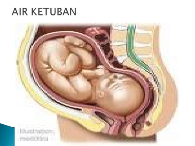 EPISIOTOMI & AMNIOTOMI pada pertolongan persalinan | PPT