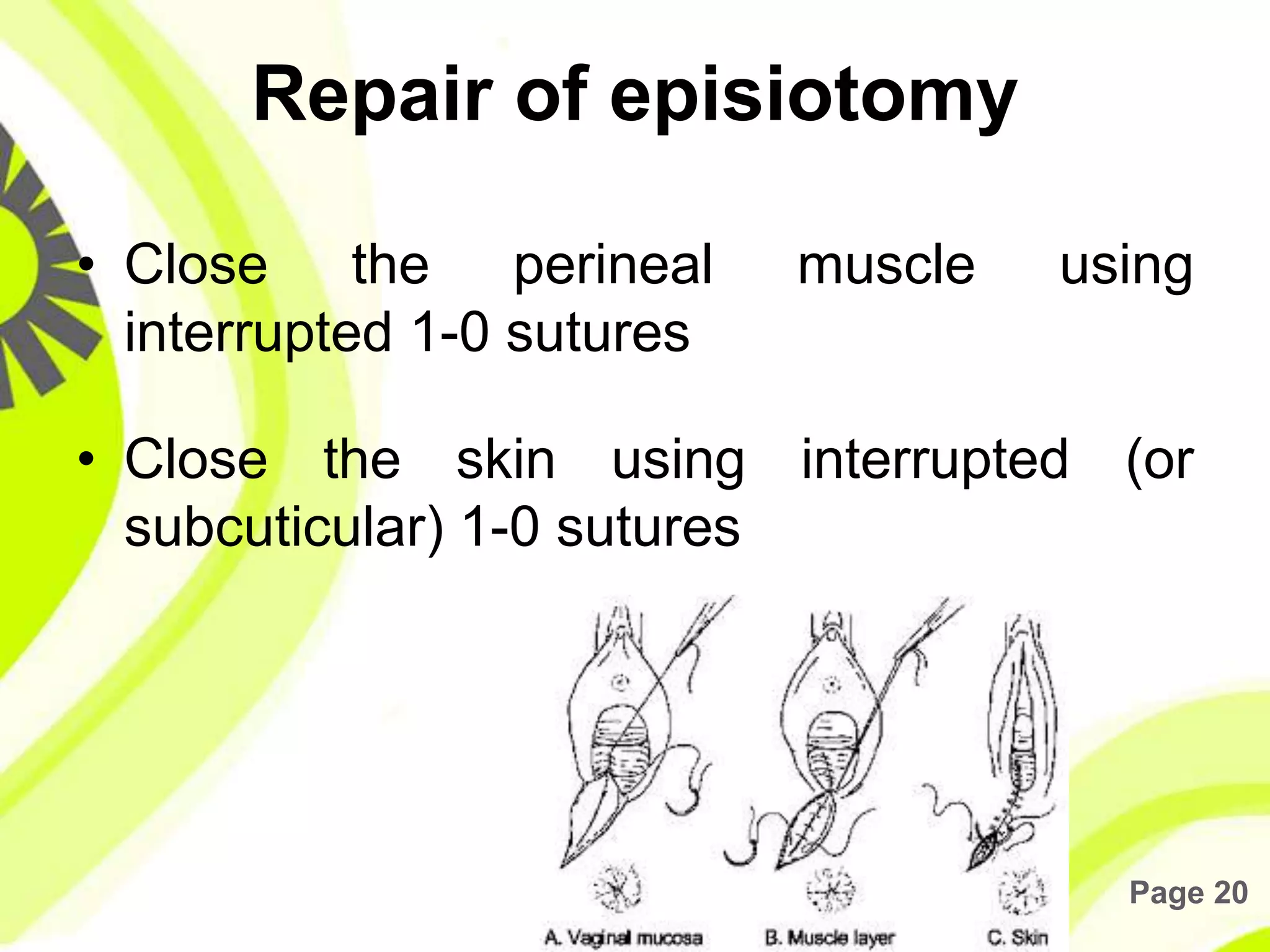 Episiotomy | PPTX