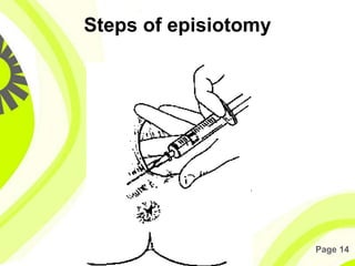 Episiotomy | PPTX