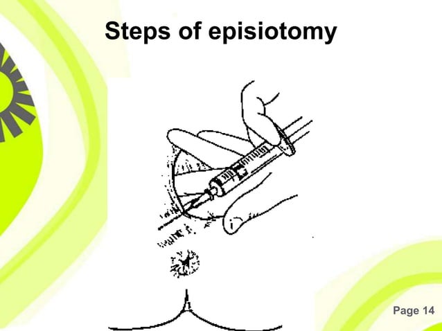 Episiotomy | PPTX | Pregnancy | Reproductive Health