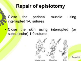Episiotomy | PPTX