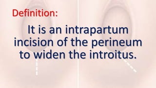 Episiotomy | PPTX