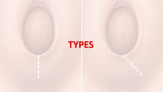 Episiotomy | PPTX