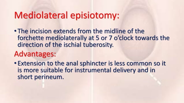 Episiotomy