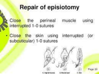 Episiotomy | PPTX