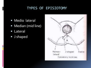 Episiotomy | PPT