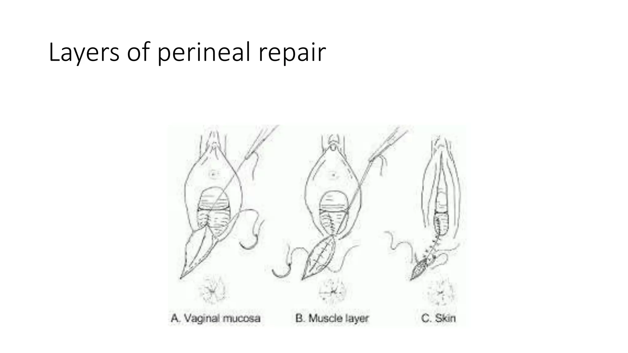 Episiotomy.pptx