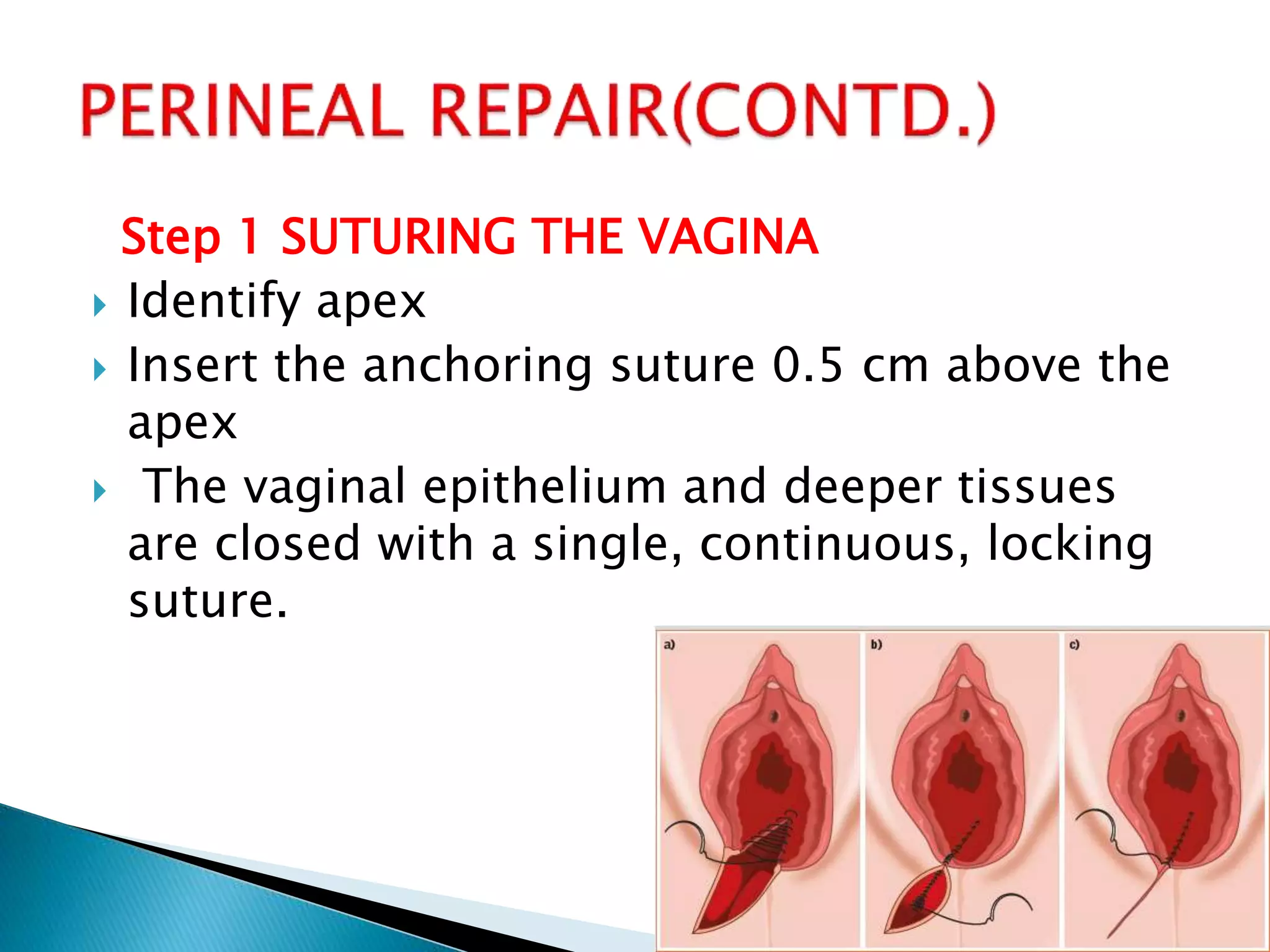 EPISIOTOMY AND ITS REPAIR.pptx