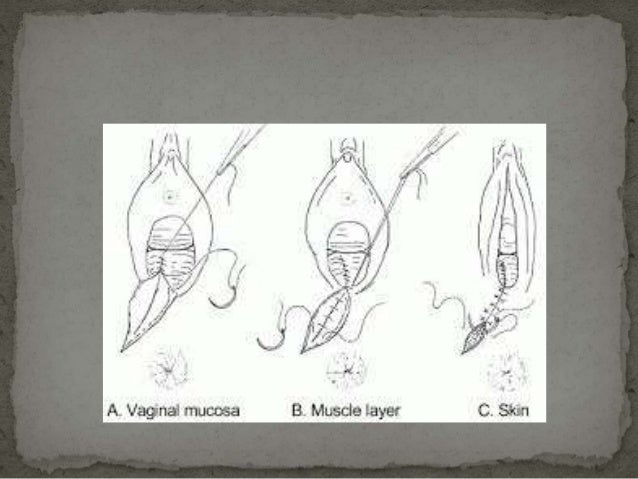 Episiotomy and version