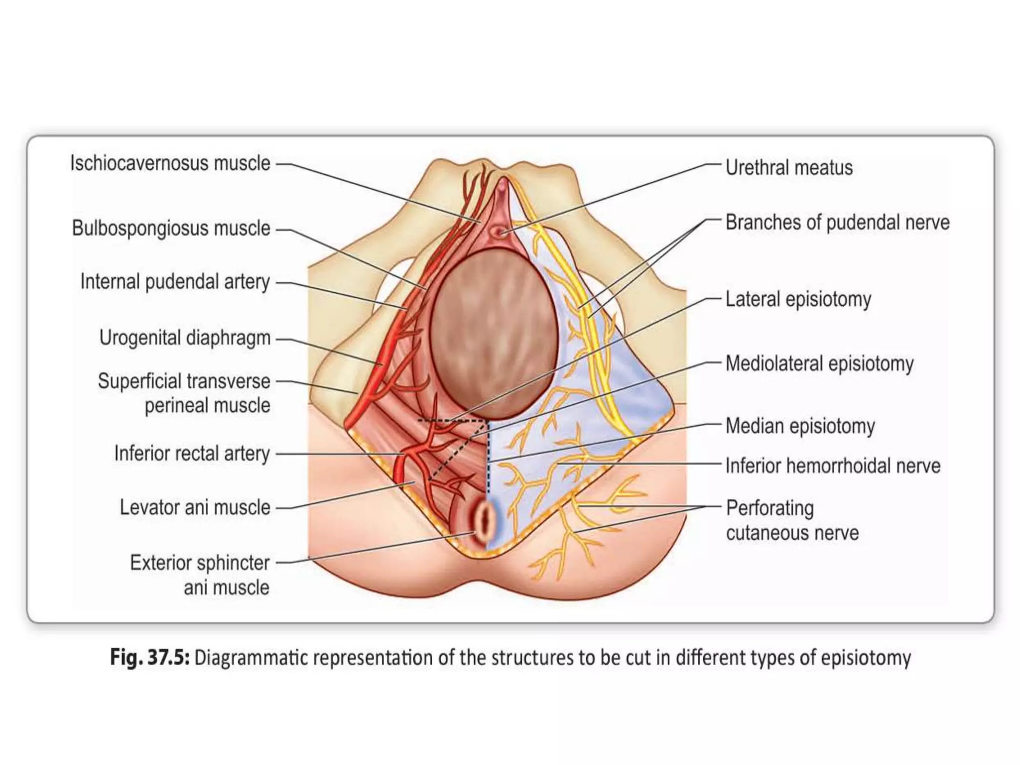 Episiotomy Pptx 8359