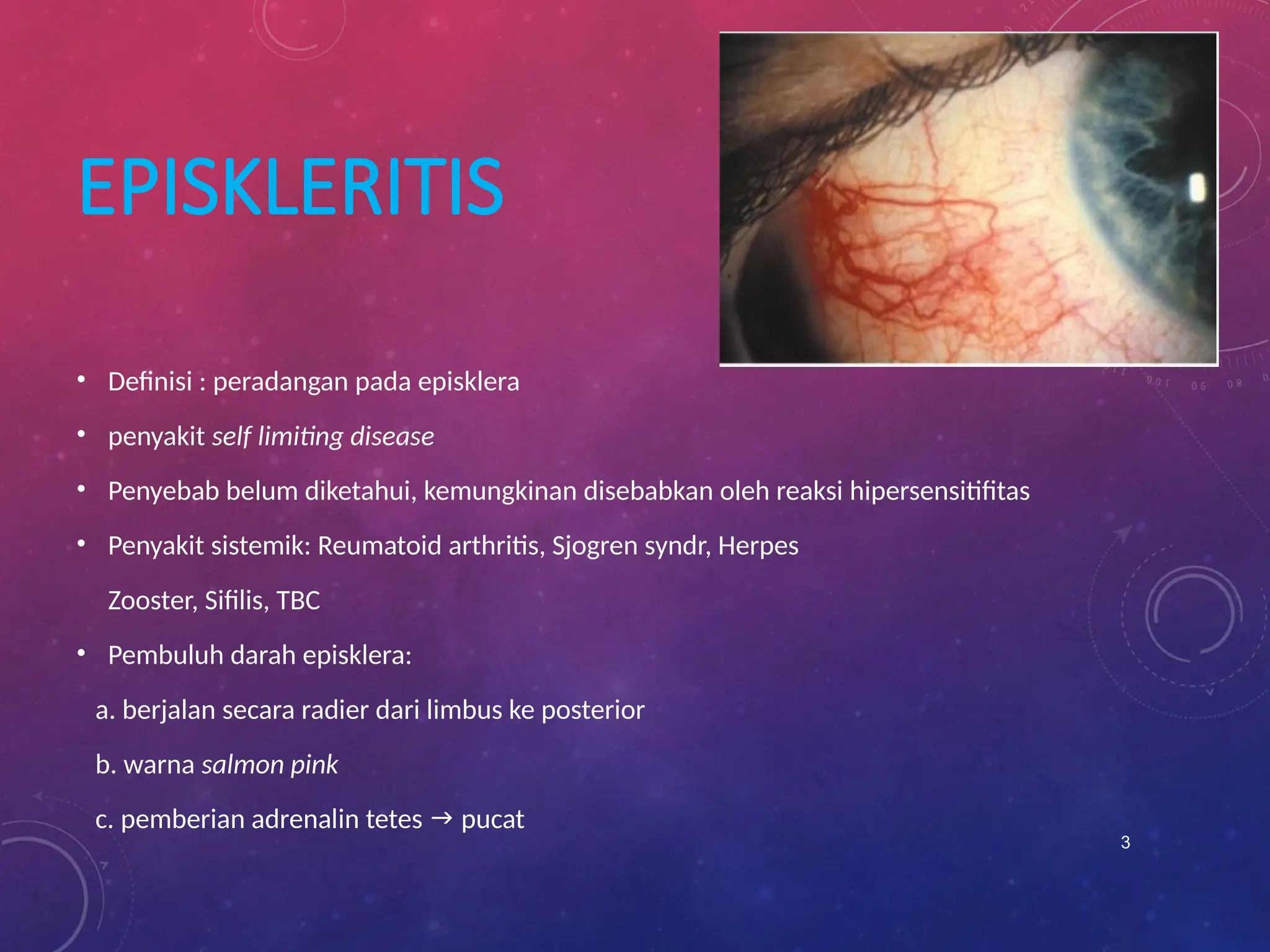 Episkleritis-Dan-Skleritis Episkleritis-Dan-Skleritis | PPT