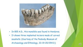 History of dentures | PPTX
