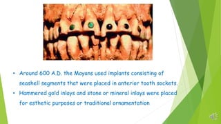 History of dentures | PPT